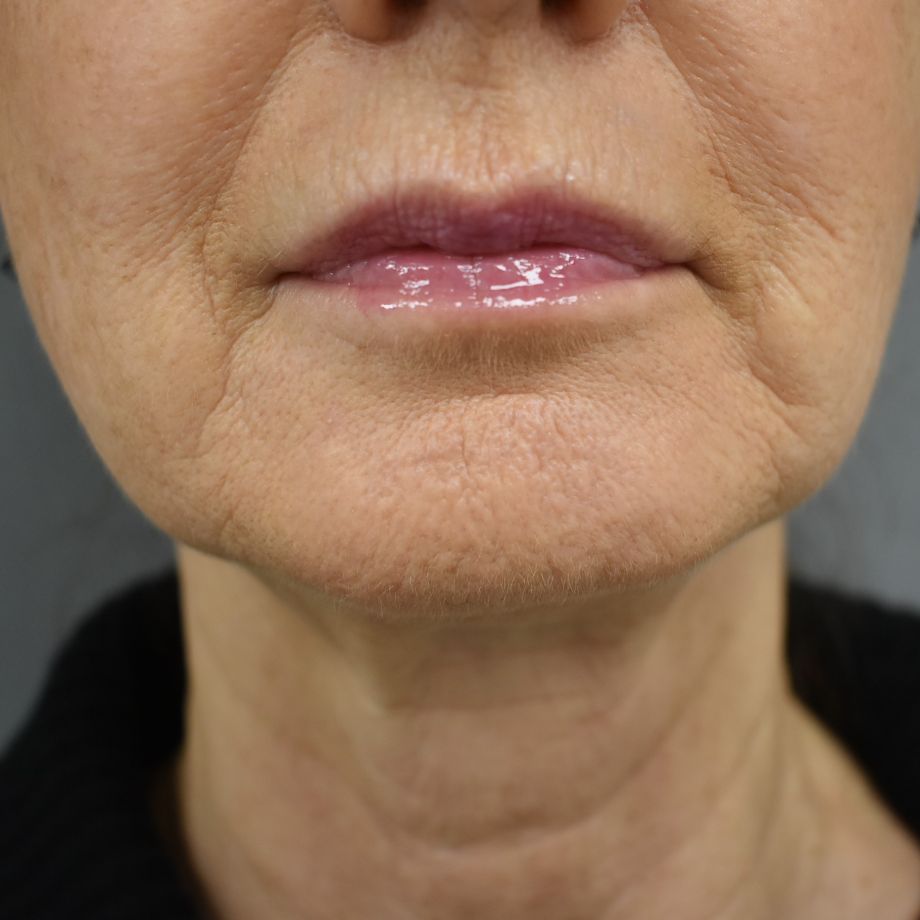 Laser Skin Resurfacing Before & After Photo Gallery | Tunbridge Wells, Kent | Nora Nugent