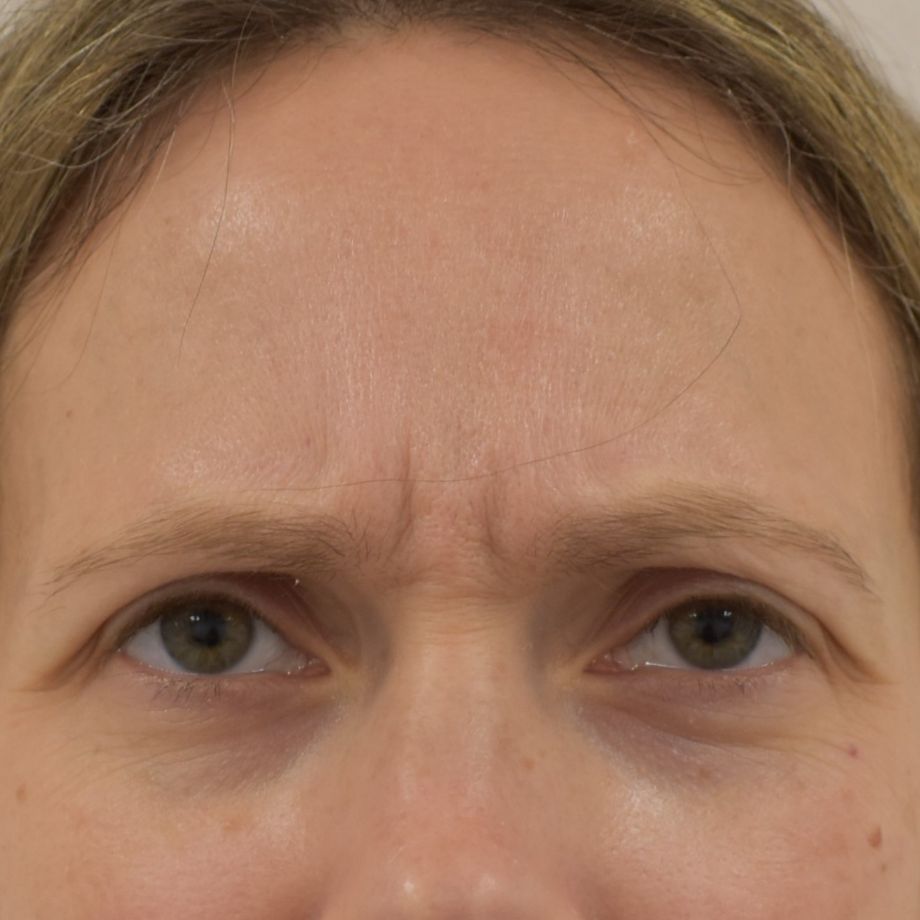 Wrinkle Reduction Before & After Photo Gallery | Tunbridge Wells, Kent ...